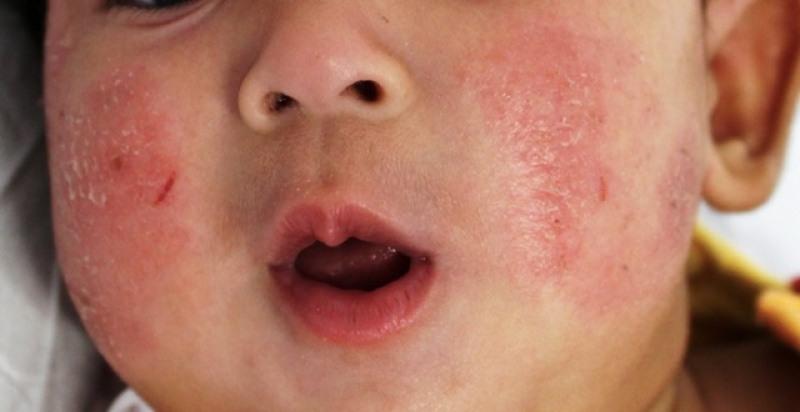 Dermatite: sintomas, como ocorre e como tratar!