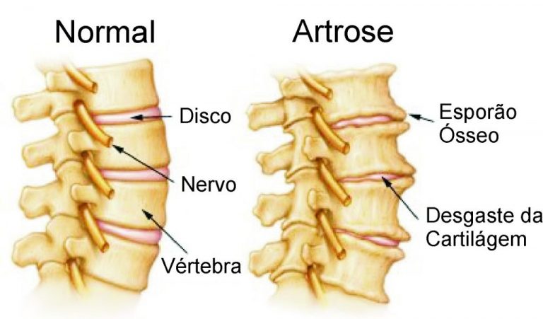 Artrose: como ocorre, sintomas e mais!
