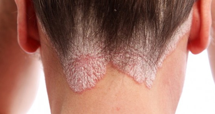 Psoríase: porque ocorre? qual o tratamento?