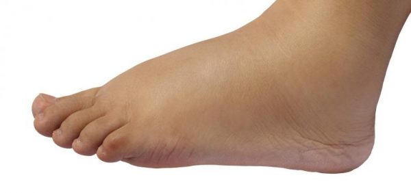 Pé inchado - por que ocorre?