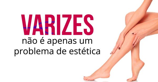 Varizes: veja os problemas que causam e tecnicas que podem ajudar!