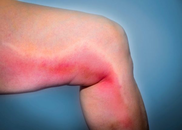 Coágulo de sangue: como é formado e quais as causas mais comuns?