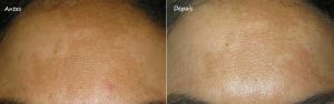 Clariderm Pomada: preço, generico, antes e depois, confira!