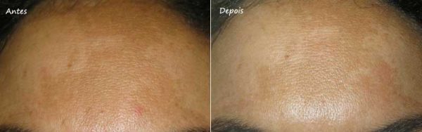 Clariderm Pomada: preço, generico, antes e depois, confira!